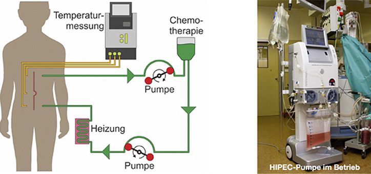 HIPEC | Universitätsklinikum Tübingen