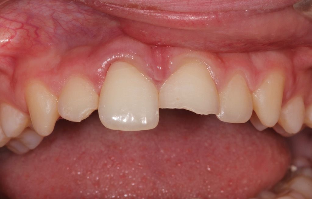 Zahnunfall | Universitätsklinikum Tübingen